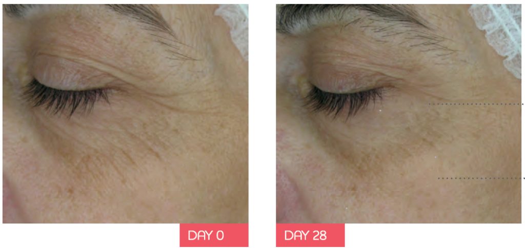 Derma Lift 5.0 - Dermaconcept